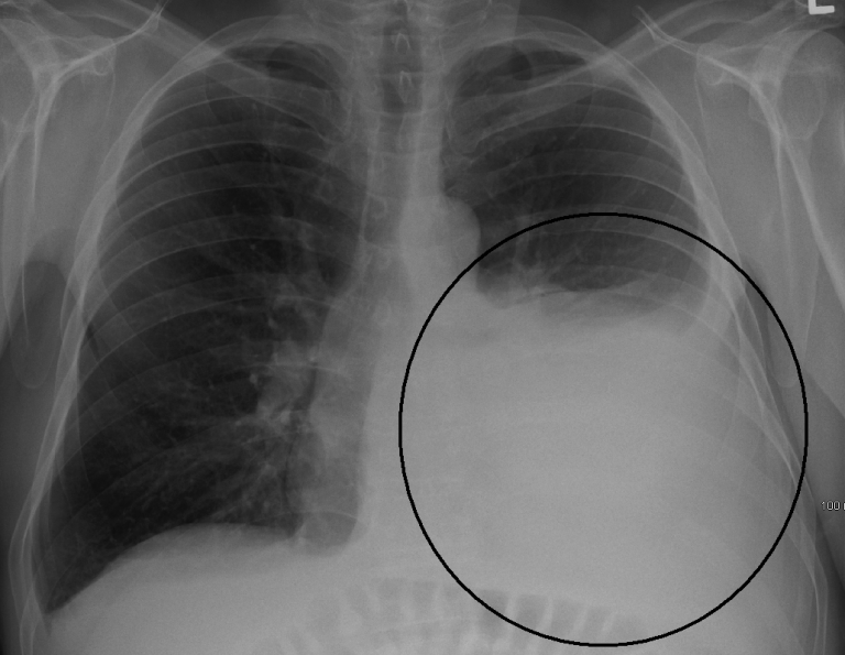 Paru paru Berair: Punca, Simptom dan Rawatan - The Diagnosa