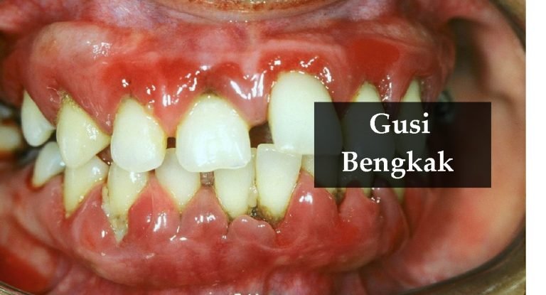 Gusi Bengkak: Punca, Simptom dan Rawatan - The Diagnosa