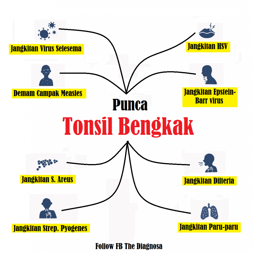 Tonsil Bengkak: Punca, Simptom dan Rawatan - The Diagnosa