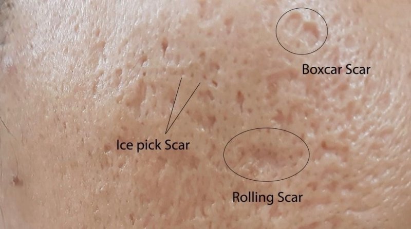 10 Cara Hilangkan Parut Jerawat yang Berkesan - The Diagnosa