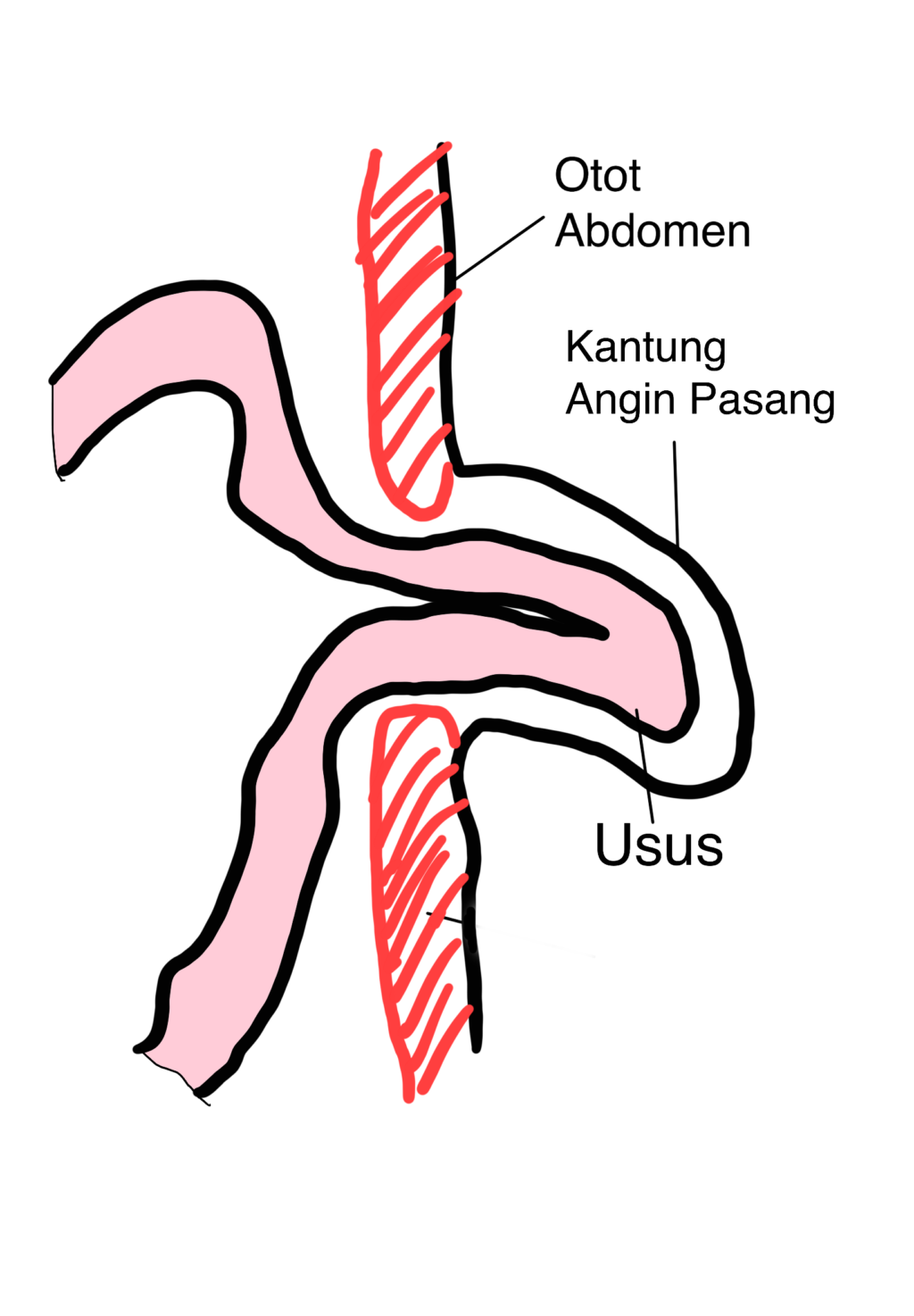 Angin Pasang (Hernia): Punca, Simptom dan Rawatan - The Diagnosa