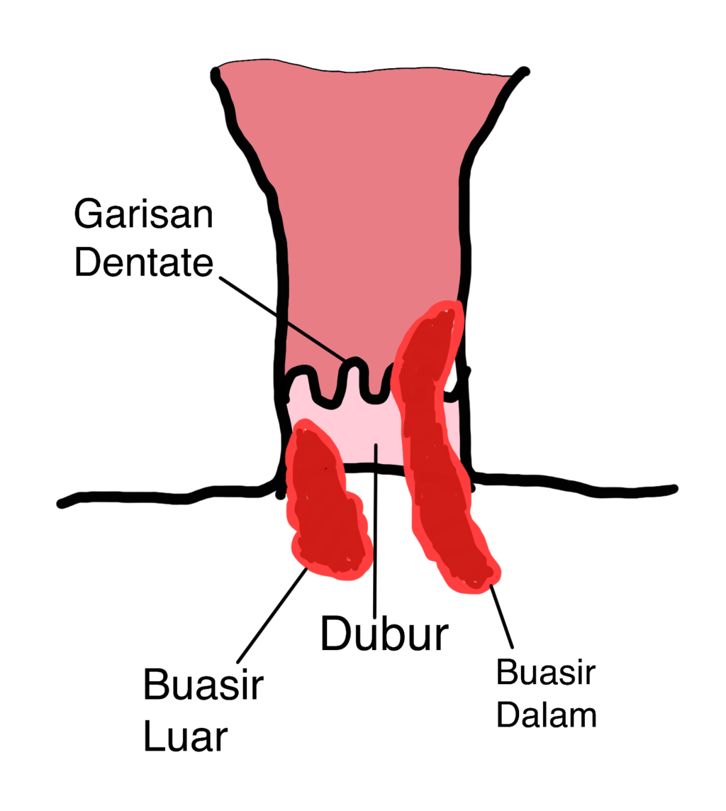 Buasir: Punca, Tanda dan Rawatan - The Diagnosa